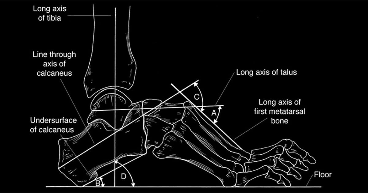 CMT Guide › CMT Type 1 › Helios Bracing