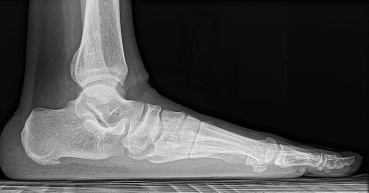 CMT Guide › CMT Type 2 › Helios Bracing